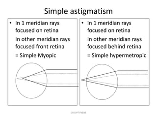 Astigmatism complete | PPT
