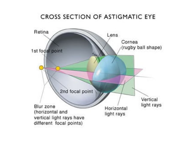 Astigmatism By Sumayya Naseem | PPT