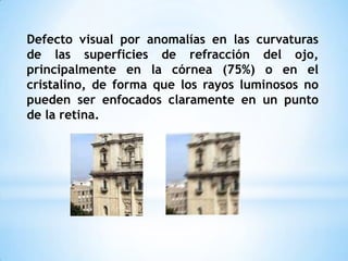 Astigmatismo | PPTX