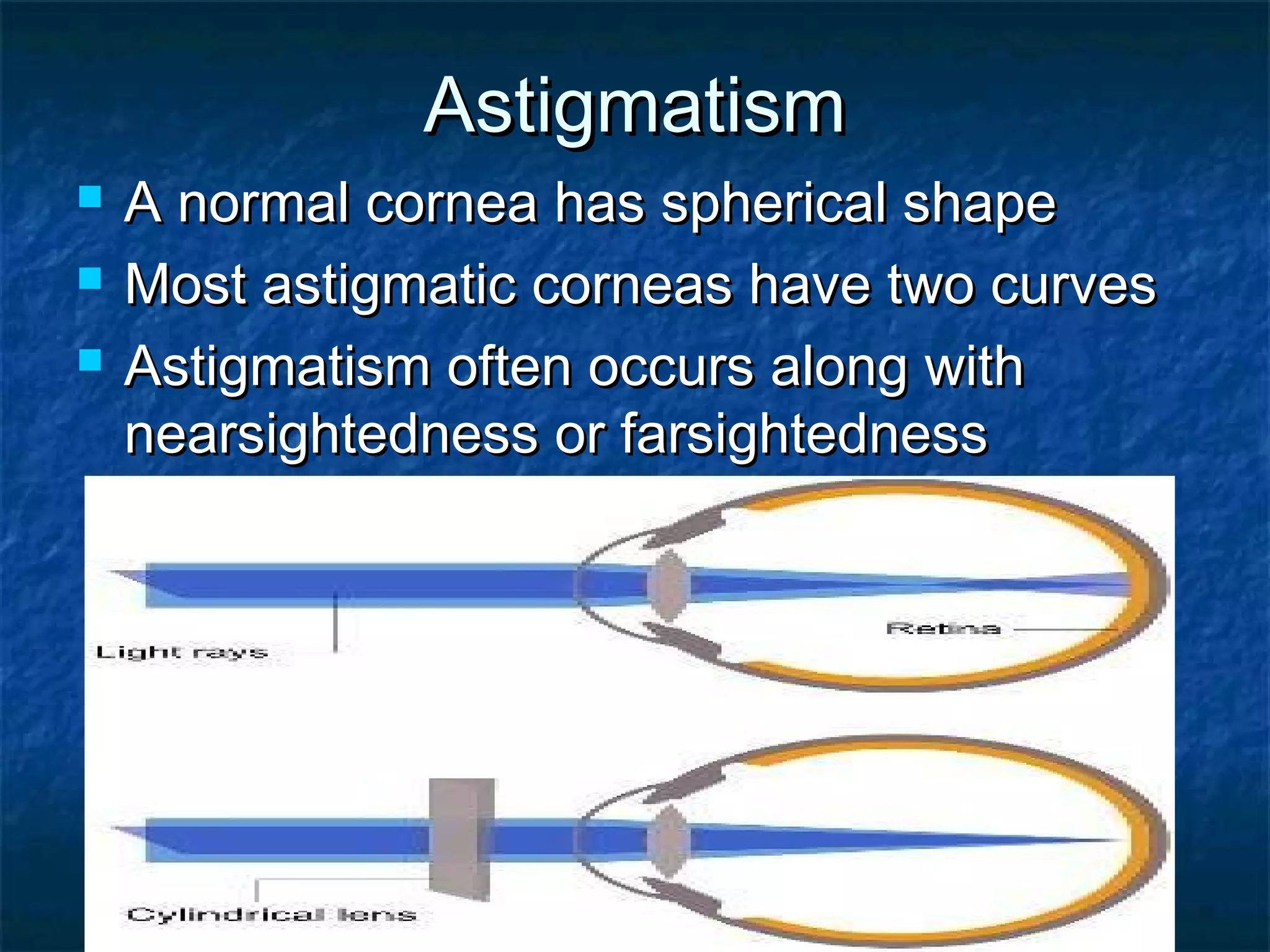 Astigmatism - Common Eye Condition | PPT