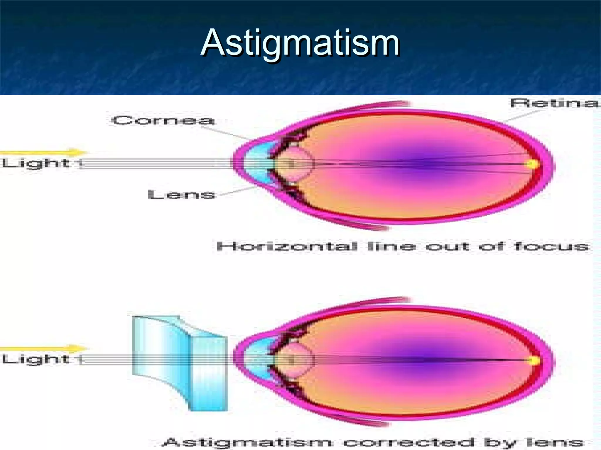 Astigmatism - Common Eye Condition | PPT