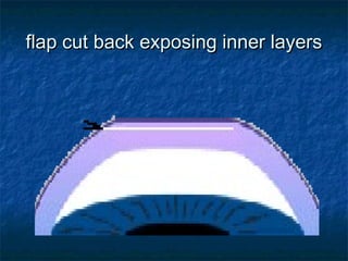 Astigmatism - Common Eye Condition | PPT