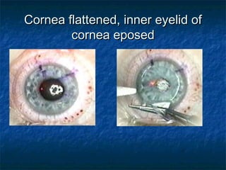 Astigmatism - Common Eye Condition | PPT