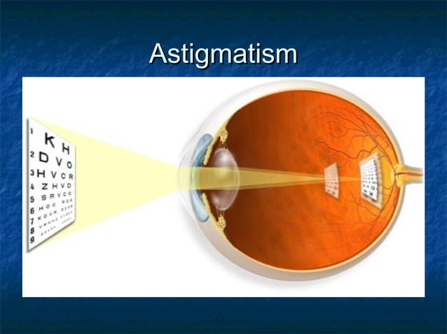 Astigmatism - Common Eye Condition | PPT