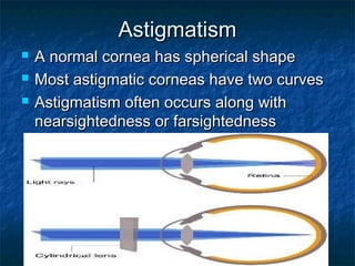 Astigmatism - Common Eye Condition | PPT