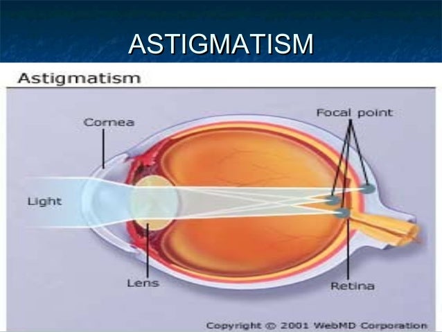 Astigmatism - Common Eye Condition
