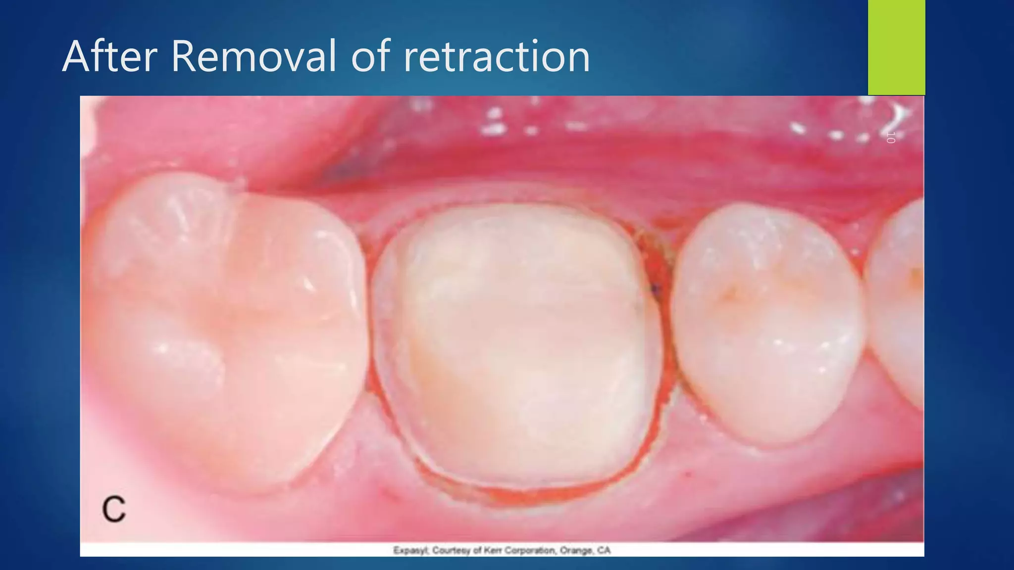 Astrigents and Gingival Retraction, Digital Impressions, Inelastic ...