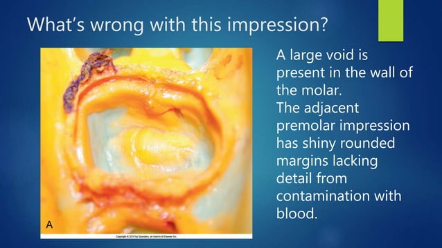 Astrigents and Gingival Retraction, Digital Impressions, Inelastic ...