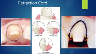 Astrigents and Gingival Retraction, Digital Impressions, Inelastic ...