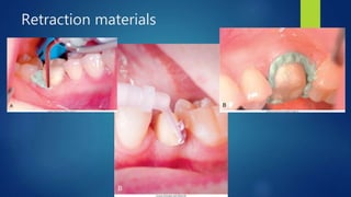 Astrigents and Gingival Retraction, Digital Impressions, Inelastic ...