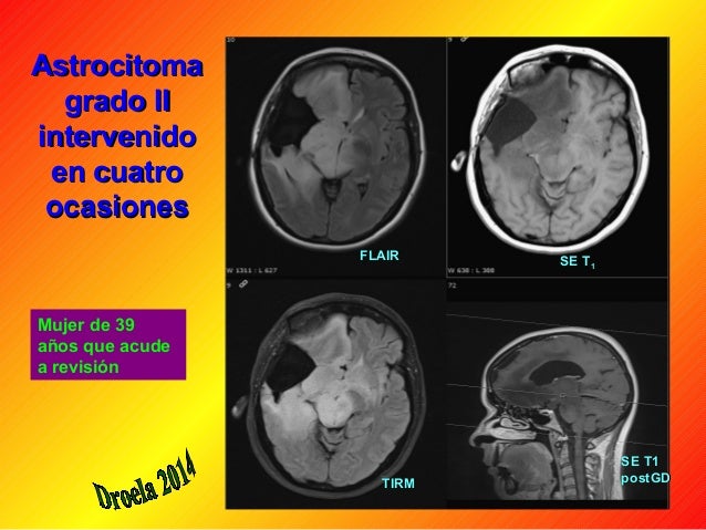 Astrocitoma grado II intervenido en cuatro ocasiones