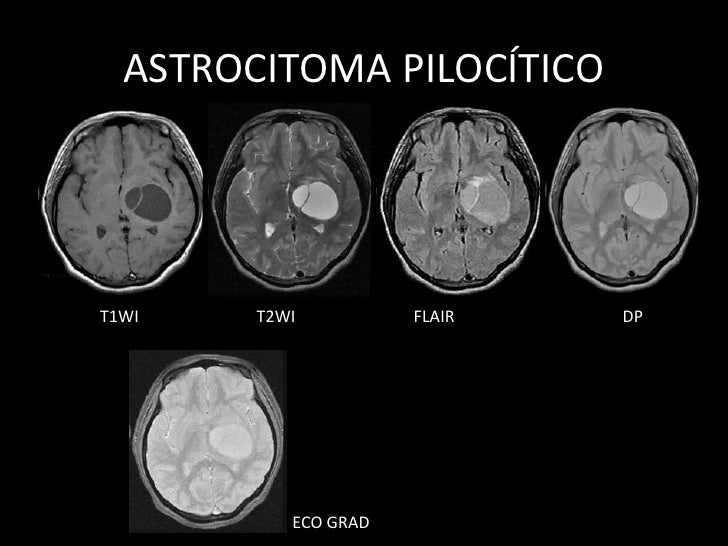 Astrocitoma PilocíTico Definitivo