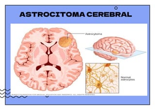 Astrocitoma y Mengiomas.pptx