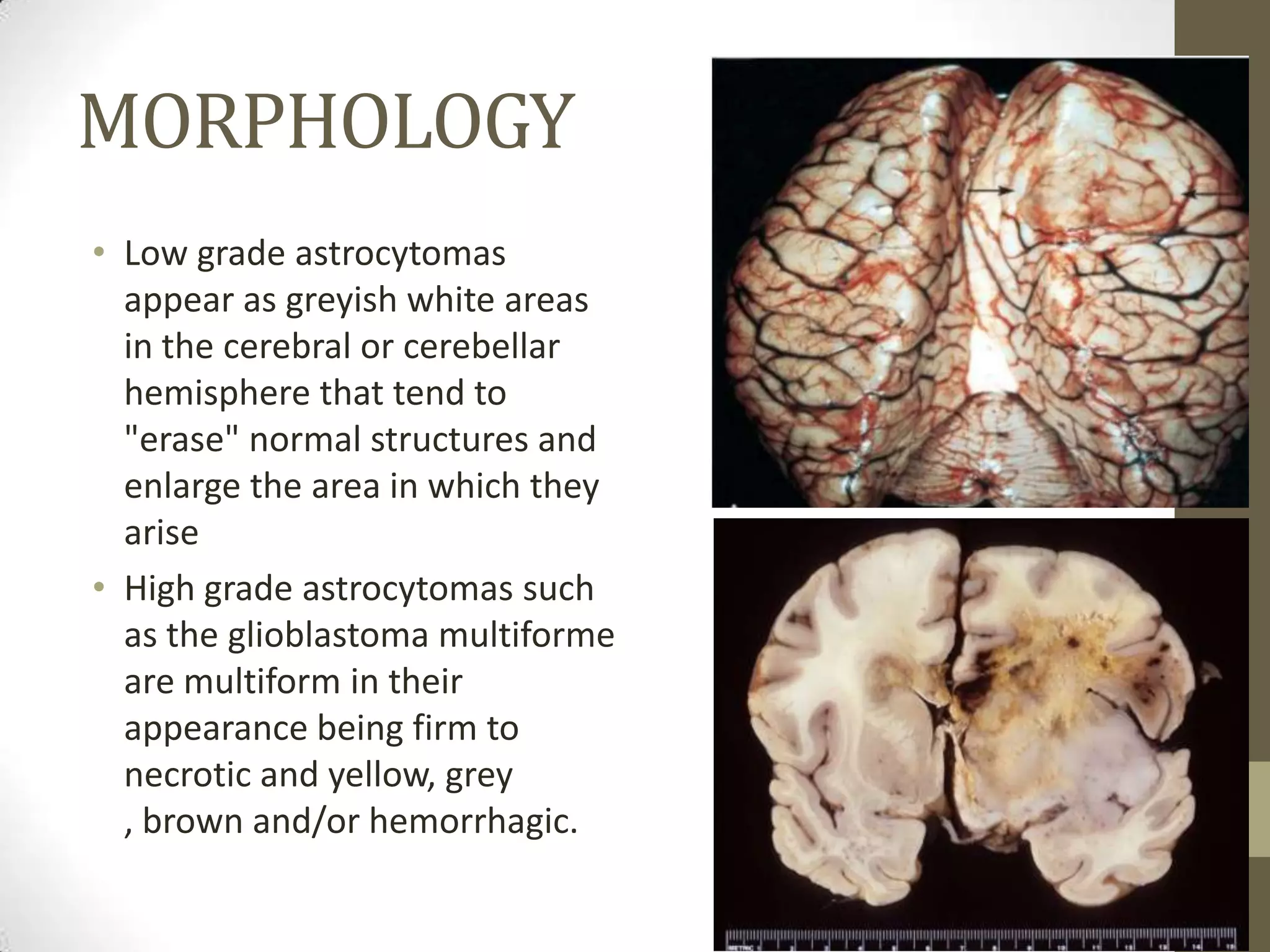 Astrocytoma | PPTX