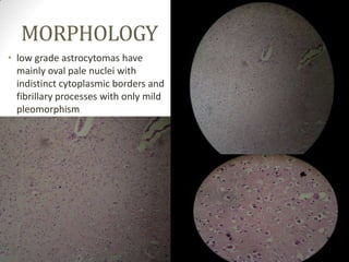Astrocytoma | PPTX