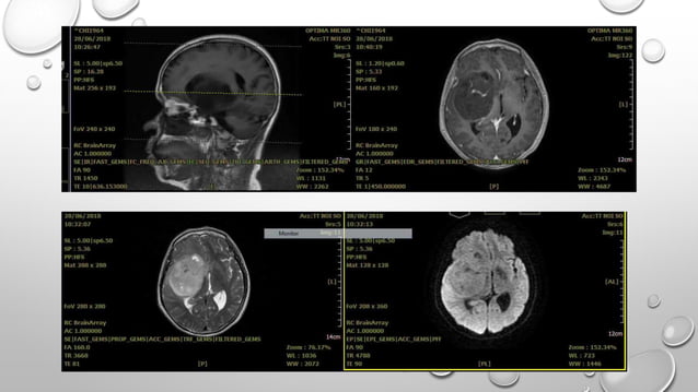 Astrocytoma.ppt | Brain and Nervous System Disorders | Diseases and ...