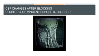 Using SOT Blocks to Remove Symptoms from Astrocytoma Surgery | PPTX