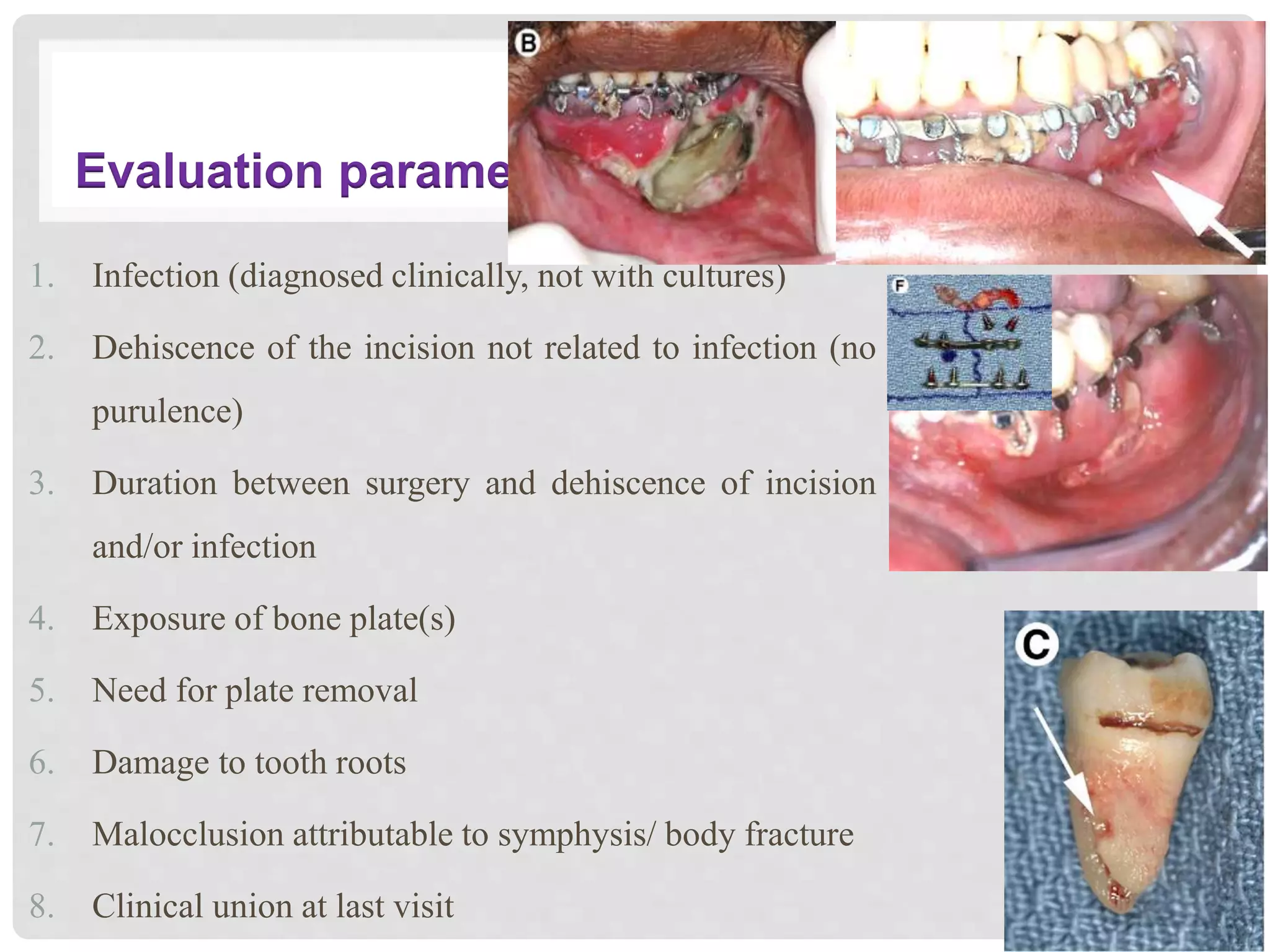 A study of 2 bone plating methods for fractures of mandibular symphysis ...