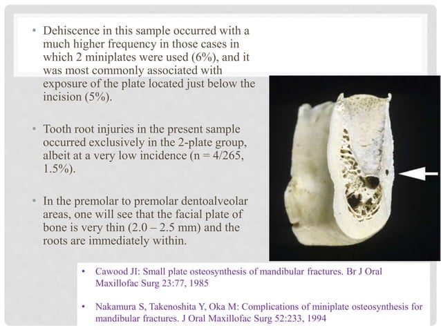 A study of 2 bone plating methods for fractures of mandibular symphysis ...