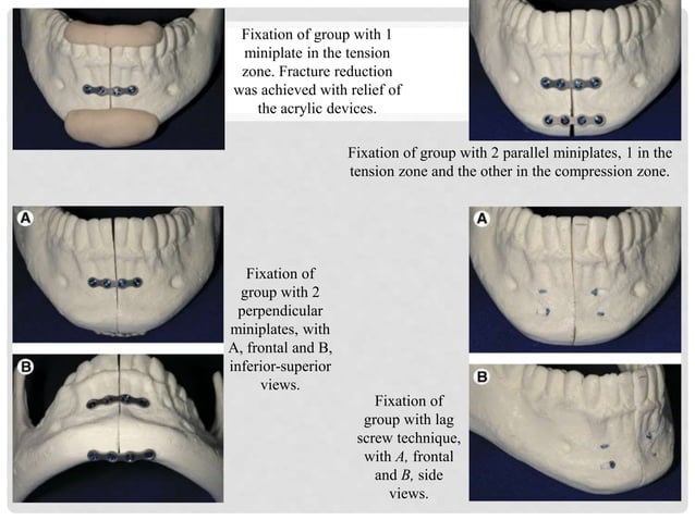 A study of 2 bone plating methods for fractures of mandibular symphysis ...