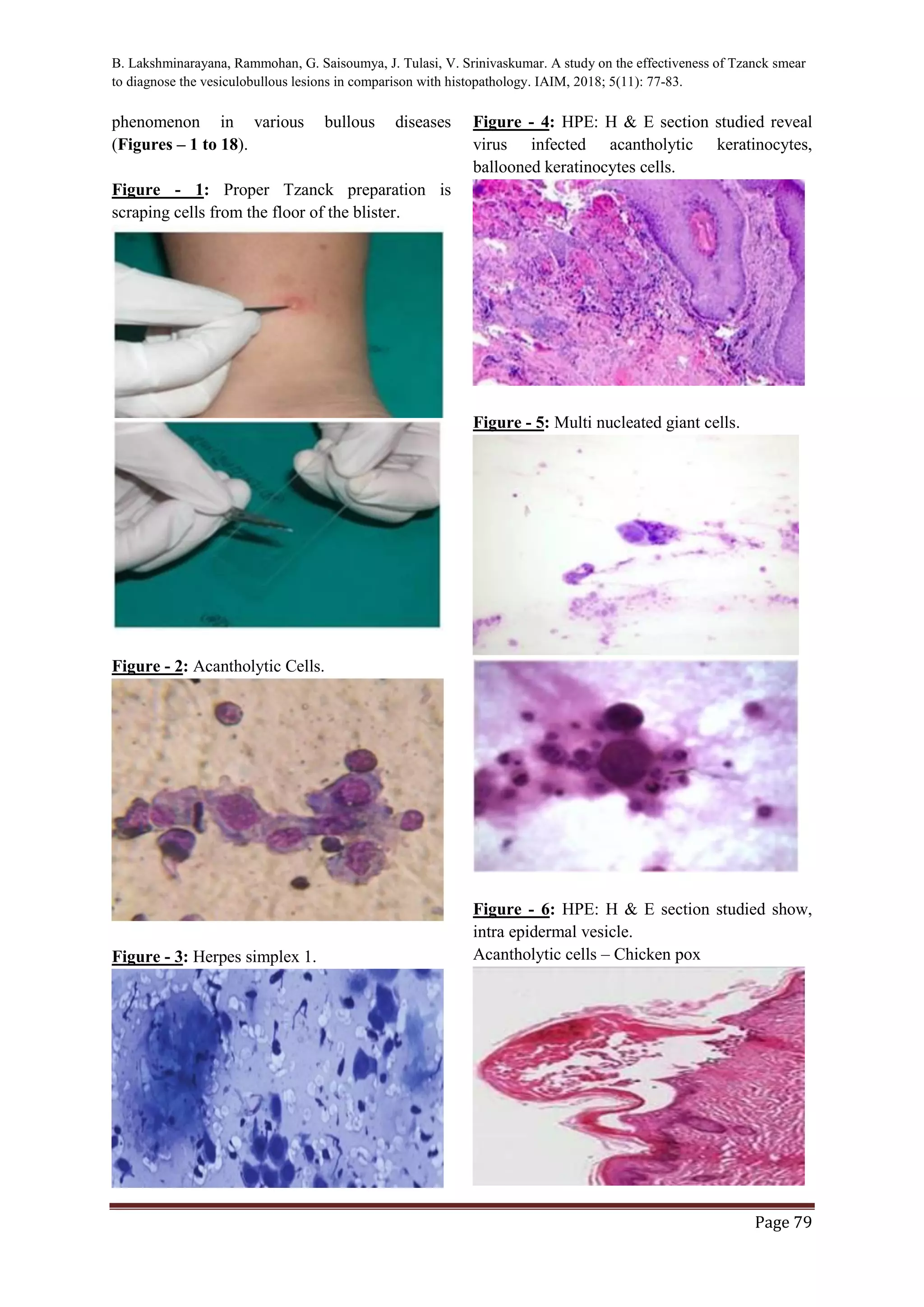 A study on the effectiveness of tzanck smear to diagnose the ...