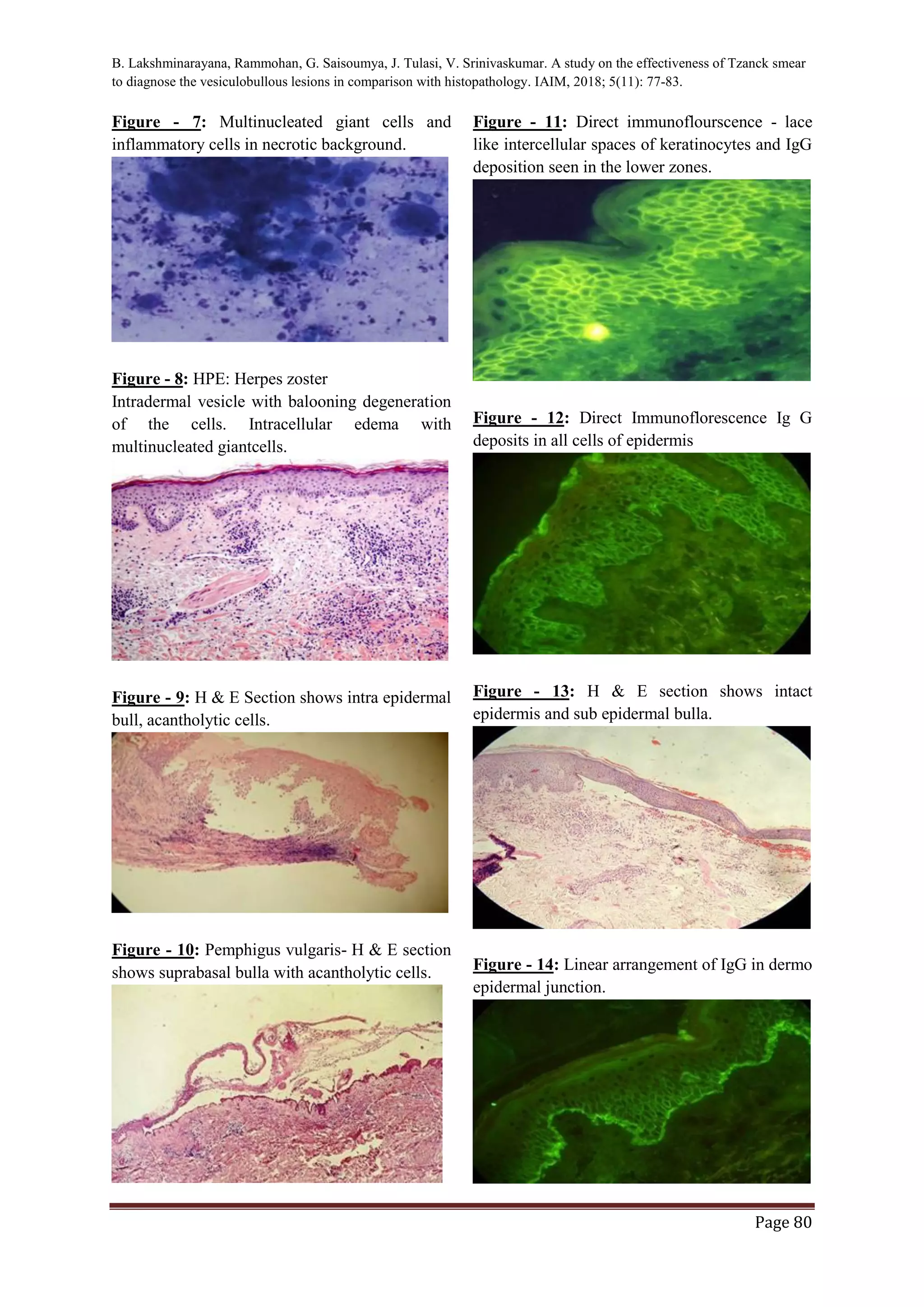 A study on the effectiveness of tzanck smear to diagnose the ...