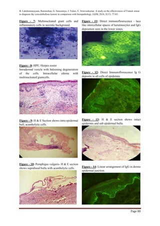 A study on the effectiveness of tzanck smear to diagnose the ...