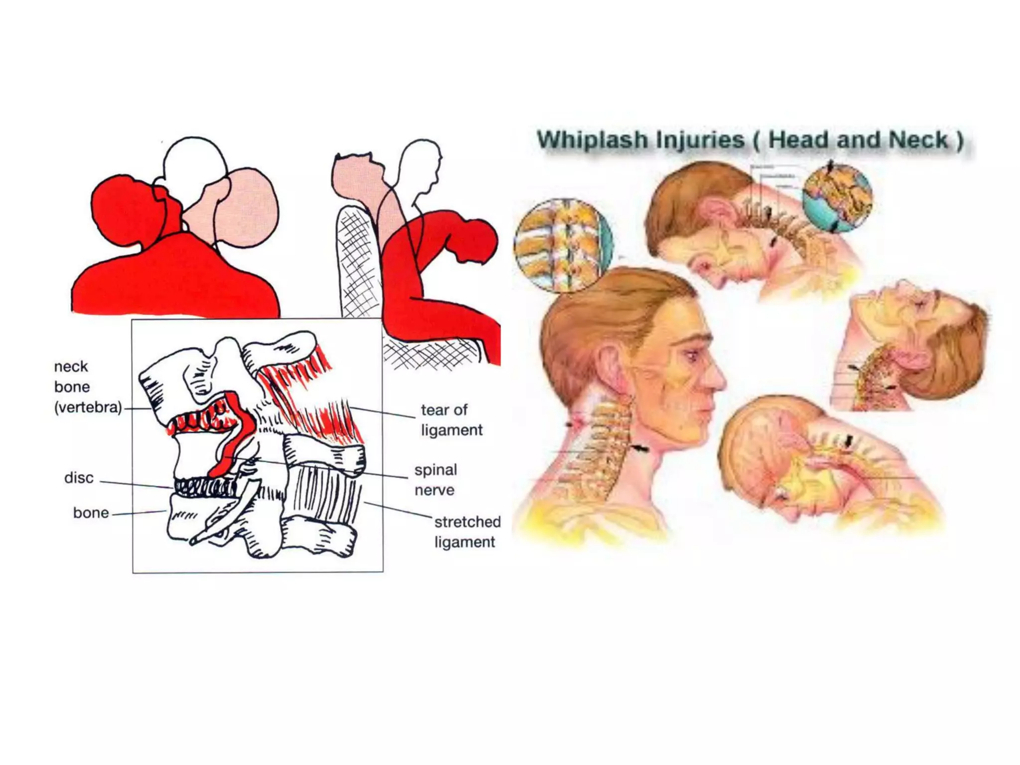 Asuhan keperawatan pada trauma medula spinalis | PDF