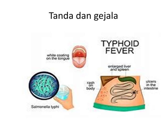 Asuhan keperawatan pada pasien dengan demam typoid.pptx