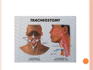 ASUHAN KEPERAWATAN PADA PASIEN TRACHEOSTOMY.pptx