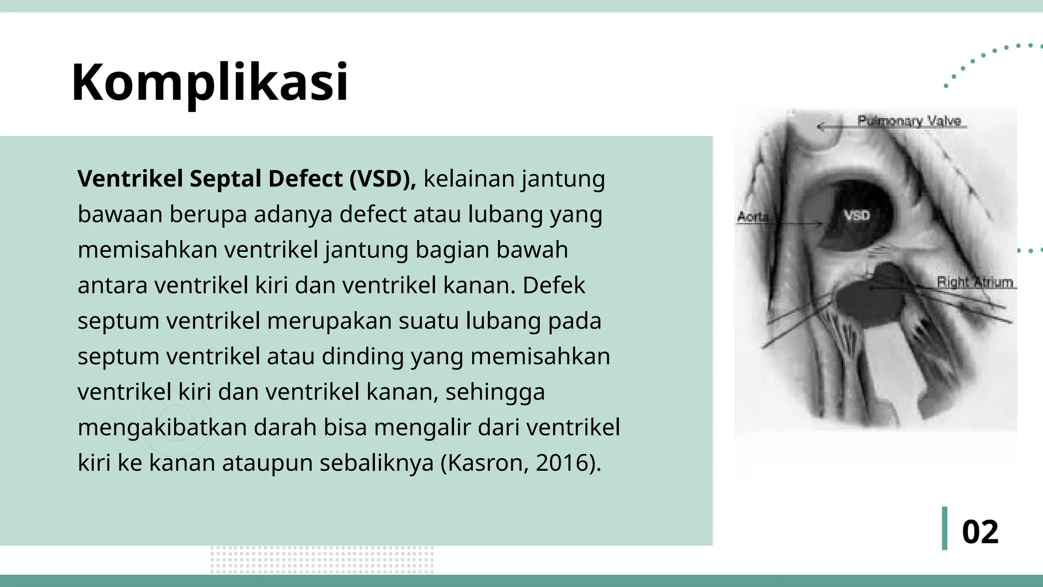 Ventricular septal defect (VSD) adalah kelainan jantung | PPTX