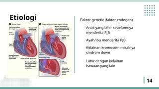 Ventricular septal defect (VSD) adalah kelainan jantung | PPTX