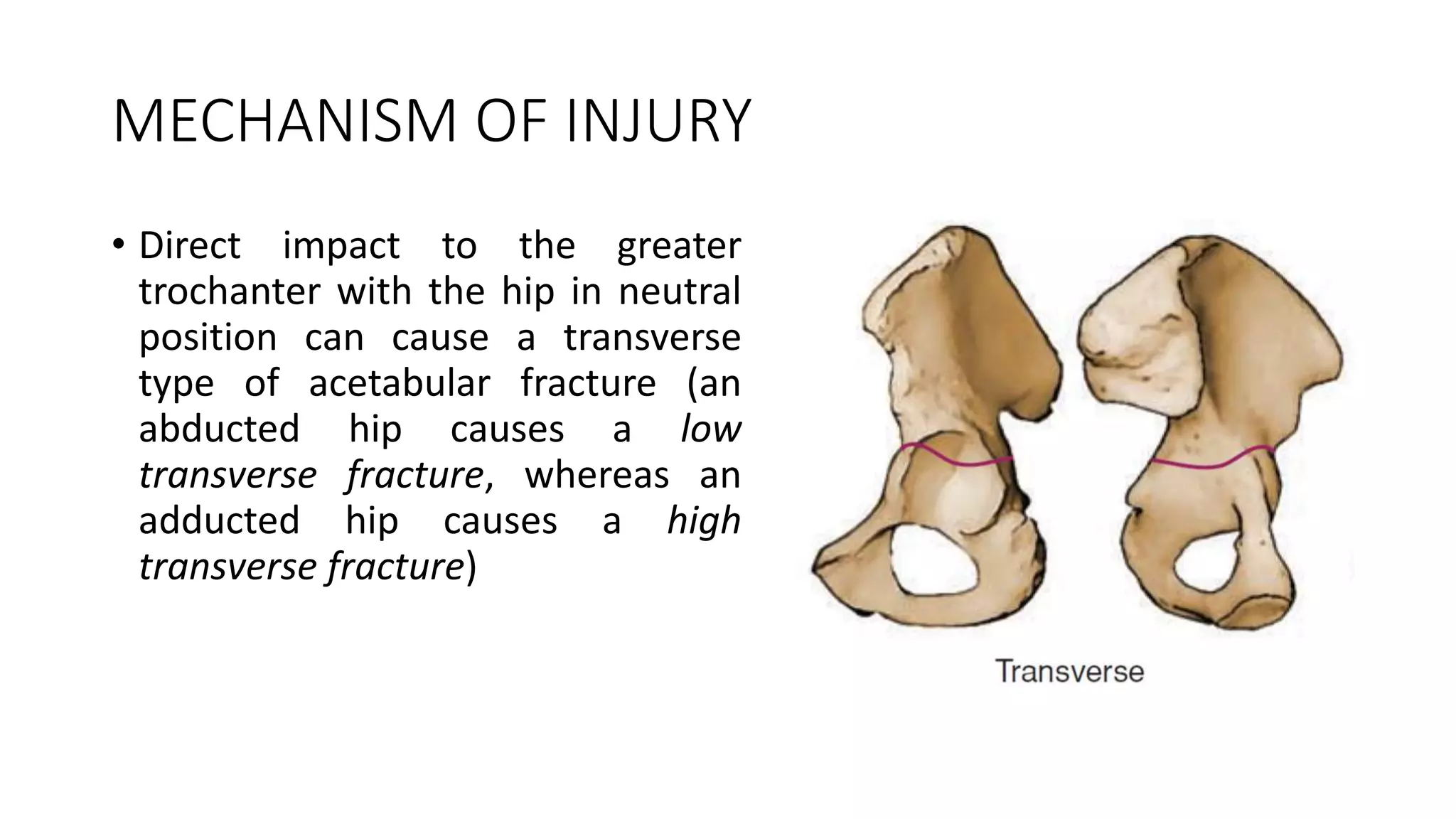 A summary of fractures of acetabulum | PPT