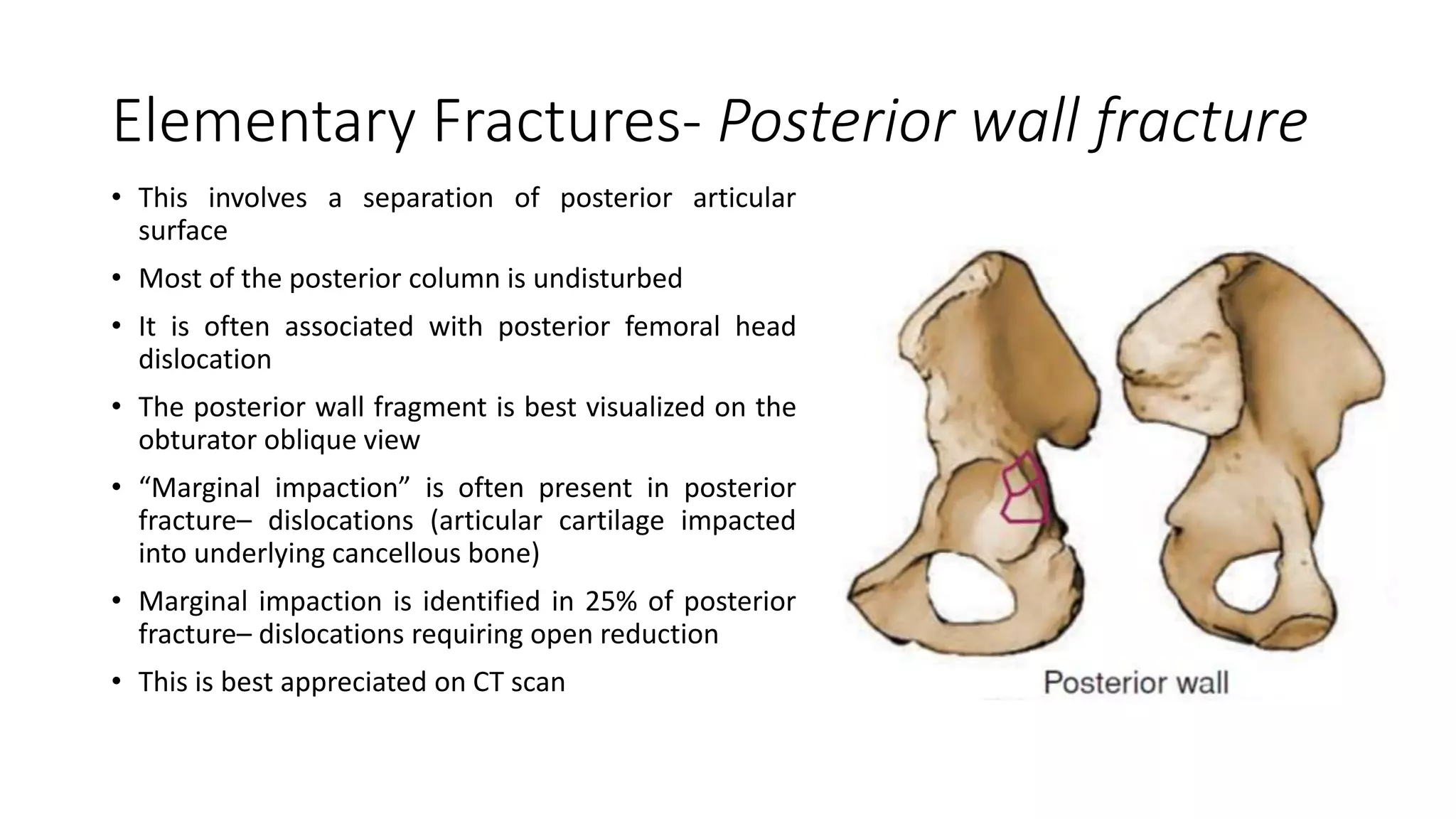 A summary of fractures of acetabulum | PPT