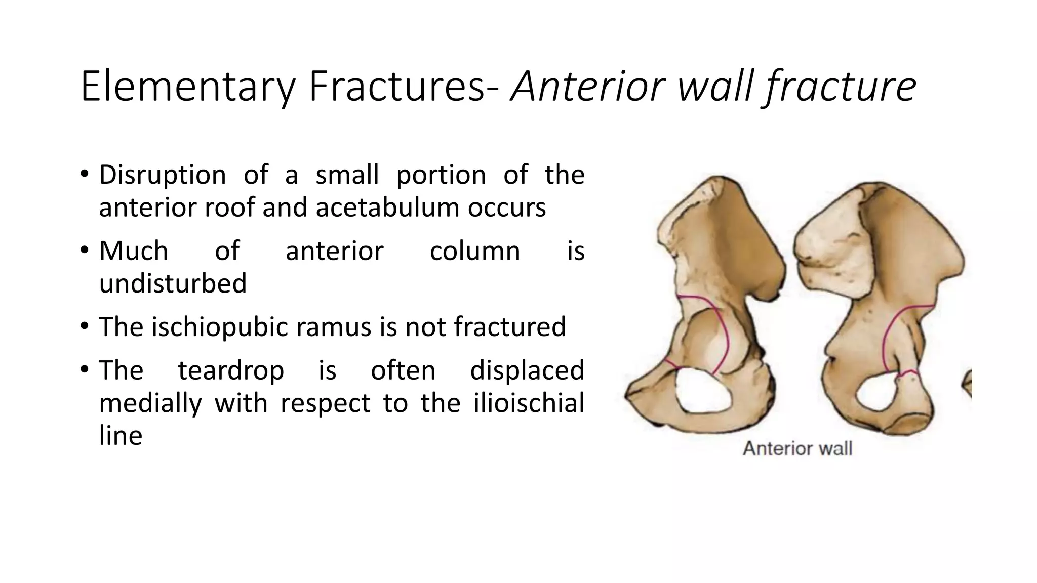 A summary of fractures of acetabulum | PPT
