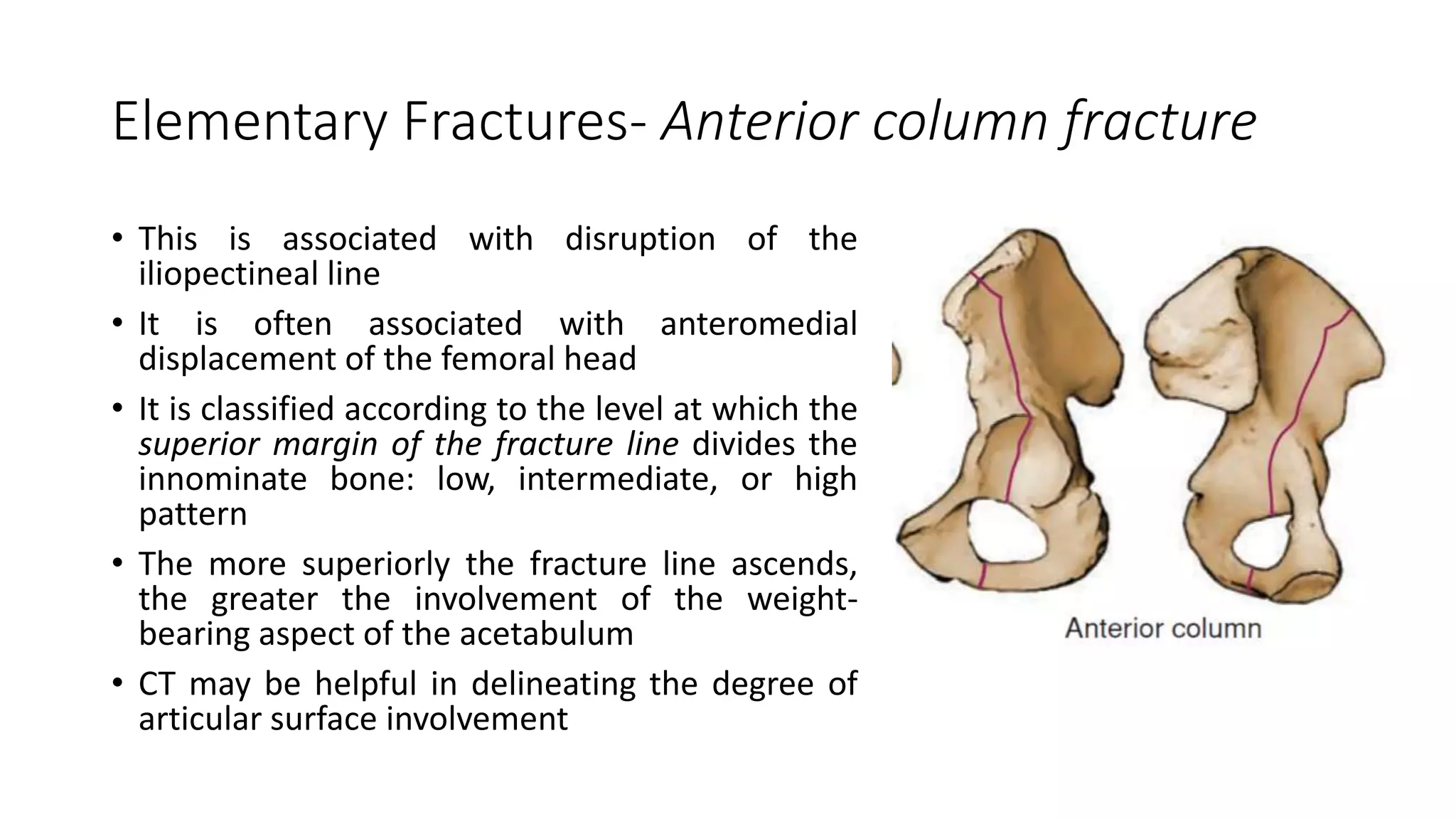 A summary of fractures of acetabulum | PPT