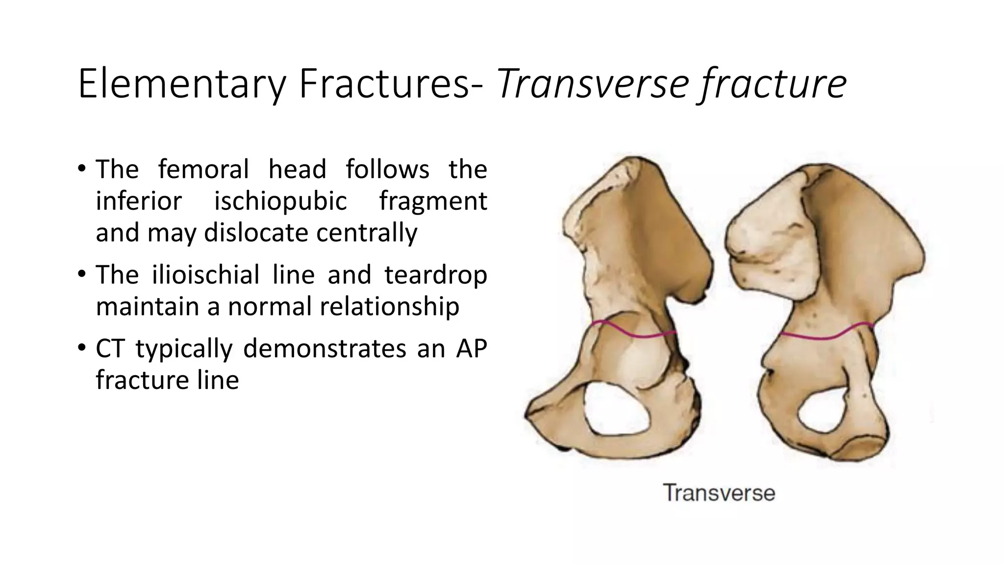 A summary of fractures of acetabulum | PPT