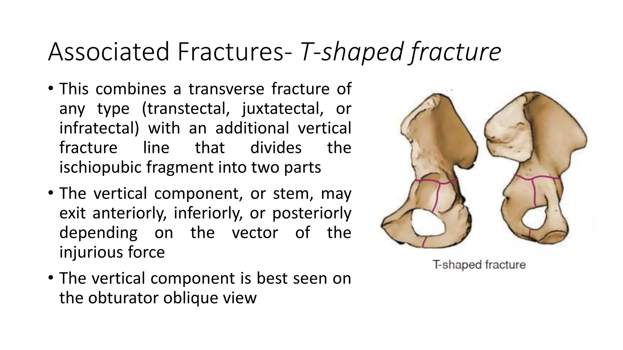 A summary of fractures of acetabulum | PPT
