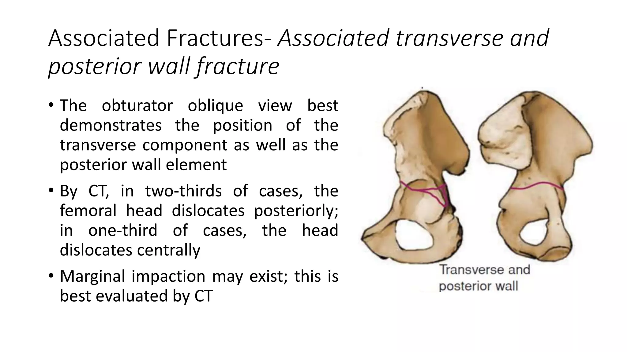 A summary of fractures of acetabulum | PPT