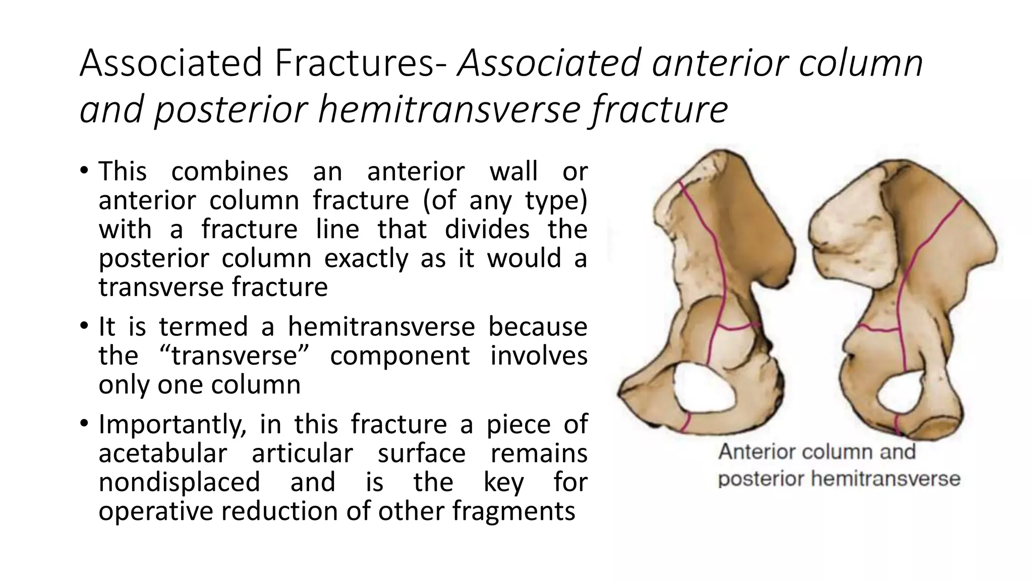 A summary of fractures of acetabulum | PPT