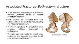 A summary of fractures of acetabulum | PPT