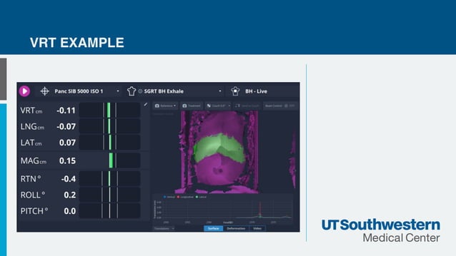 A Surface Guided Method to Improved Pancreatic SBRT Patient Experience ...
