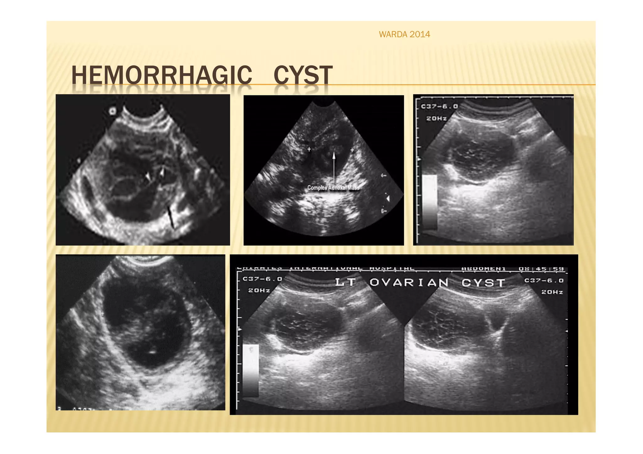 Asymptomatic palpable adnexal masses: ultrasound evaluation- warda | PPT