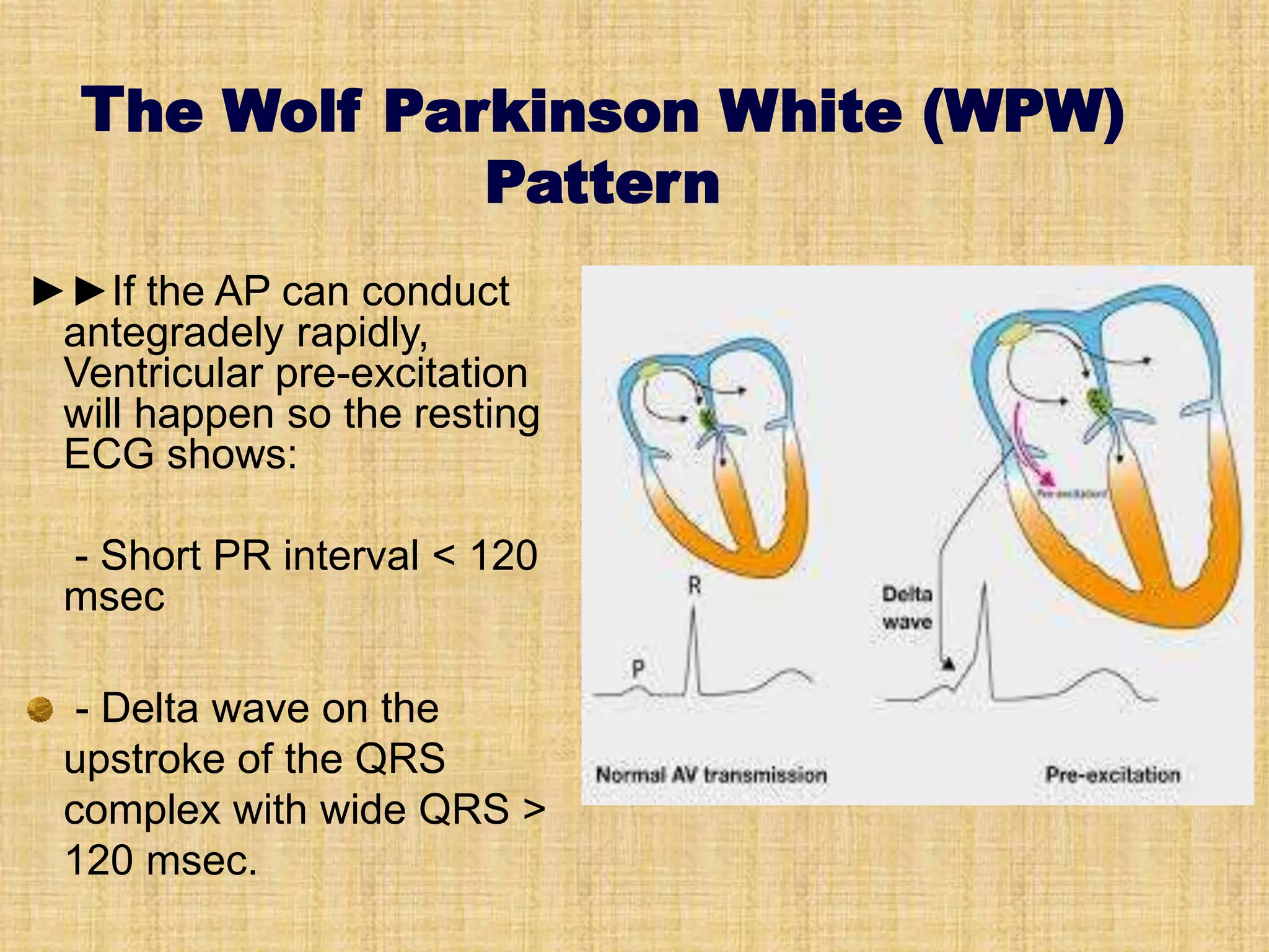 Asymptomatic WPW management | PPT | Heart and Cardiovascular Diseases ...
