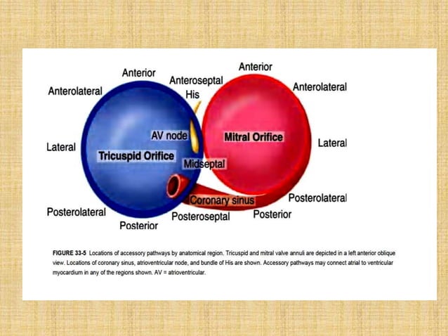 Asymptomatic WPW management | PPT
