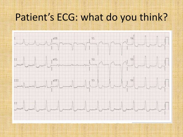 Asymptomatic WPW management | PPT