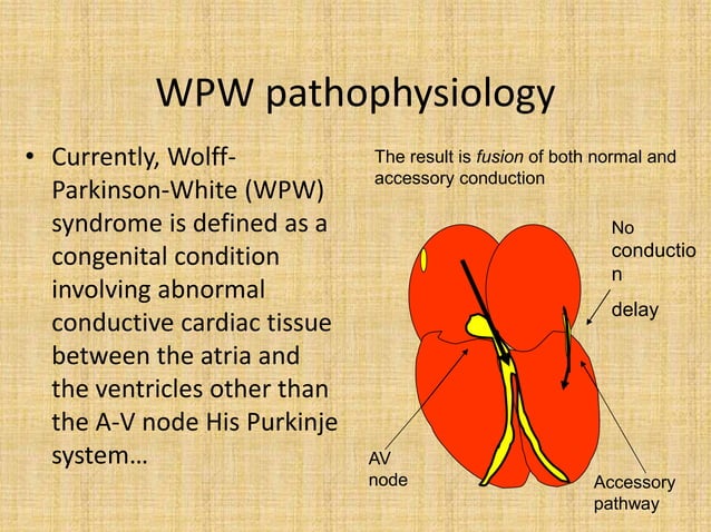 Asymptomatic WPW management | PPT
