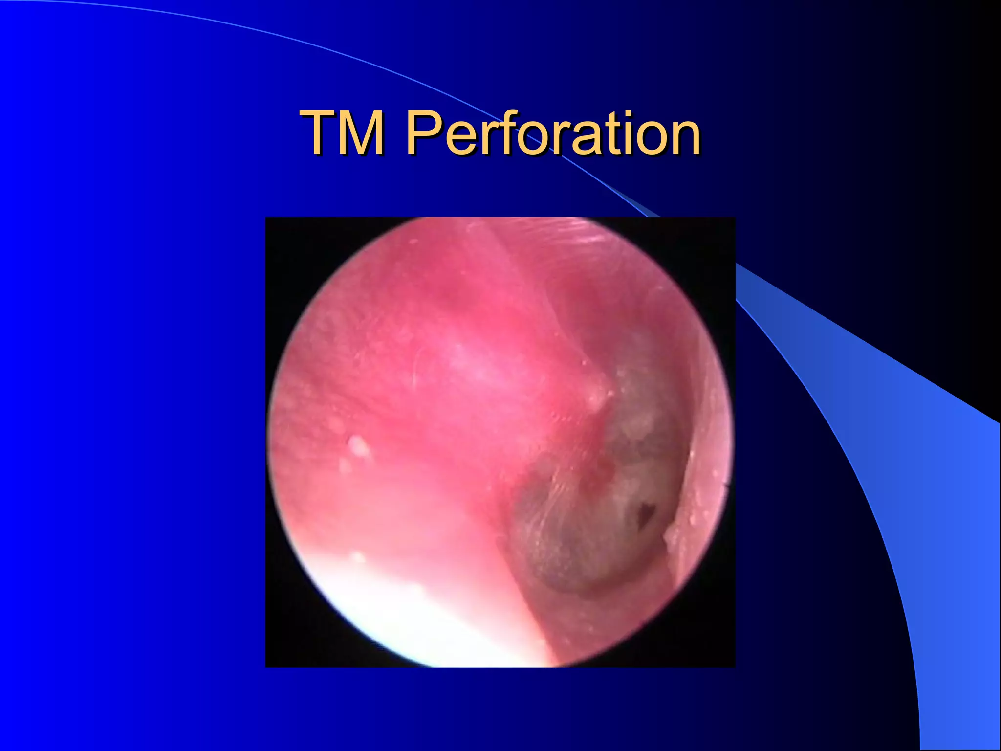 Treatment of nasal fracture by Paul of Aegina | PPT