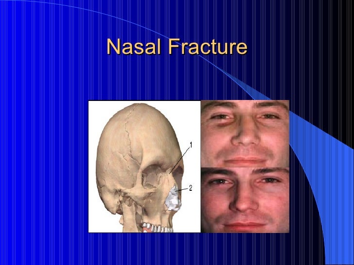 Treatment of nasal fracture by Paul of Aegina