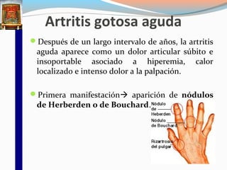 Ataque agudo de gota | PPT